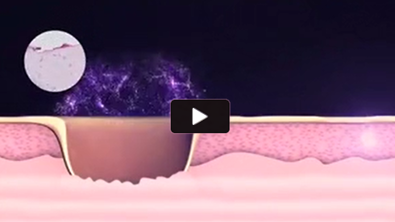Skin Resurfacing for Body | Opus Plasma Treatment | Bella Skin Center